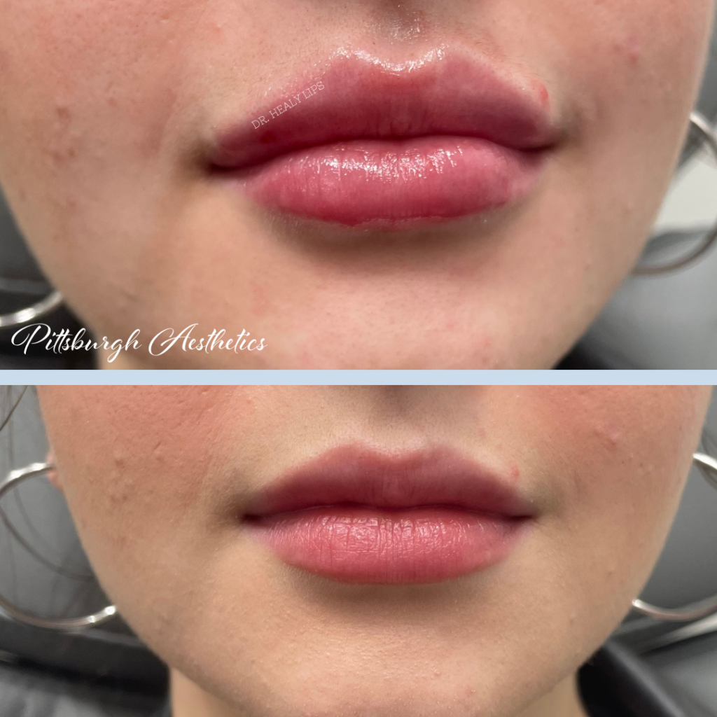 Dermal Fillers in Mars, PA | Lip, Cheek & Facial Fillers