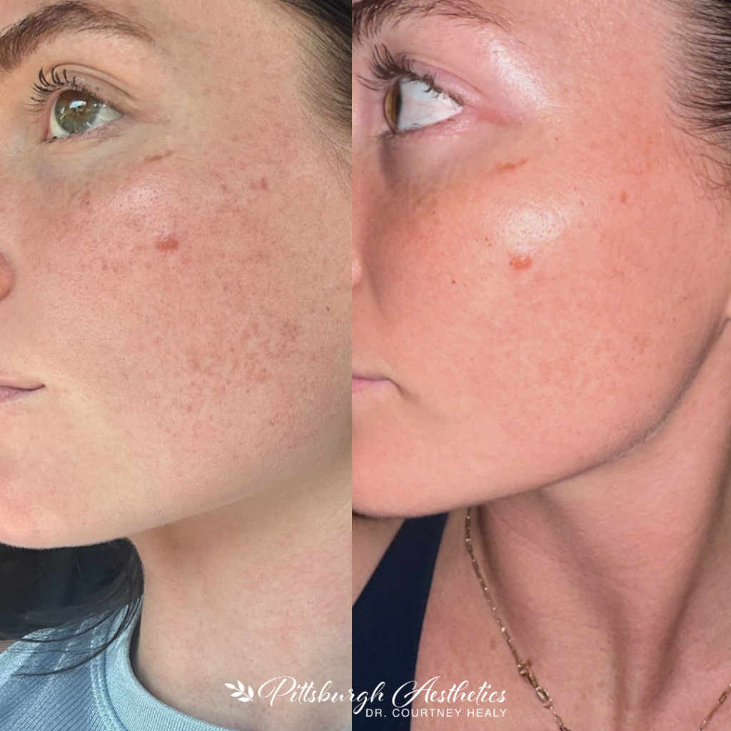 Med Spa Pittsburgh, PA | Botox, Fillers & Skincare